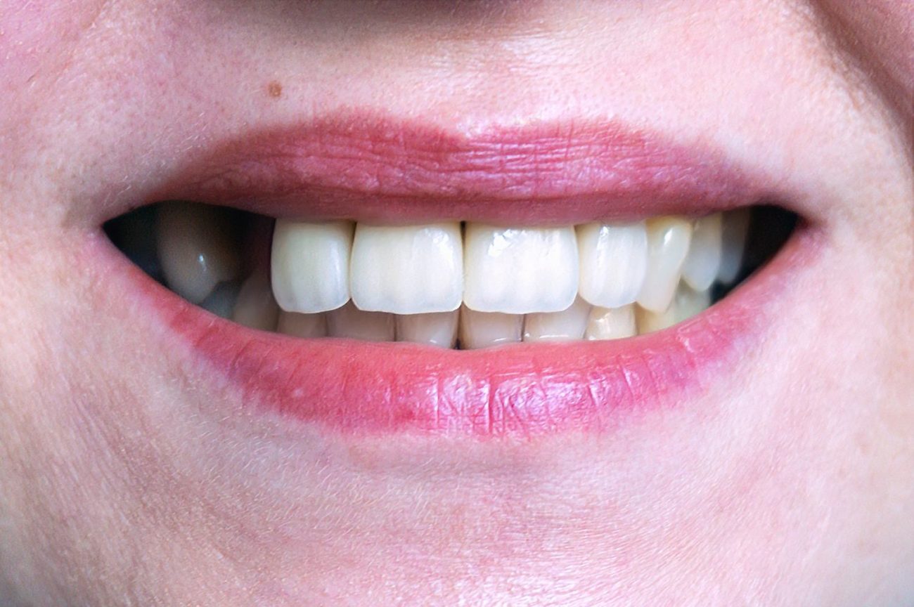 Why Replace Missing Teeth? - Midland, TX Restorative Dentist